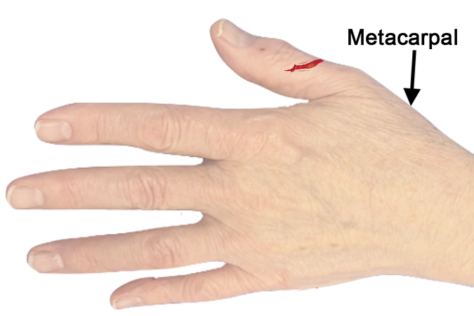 First Metacarpal Bones Exam Anatomic Structures At Risk